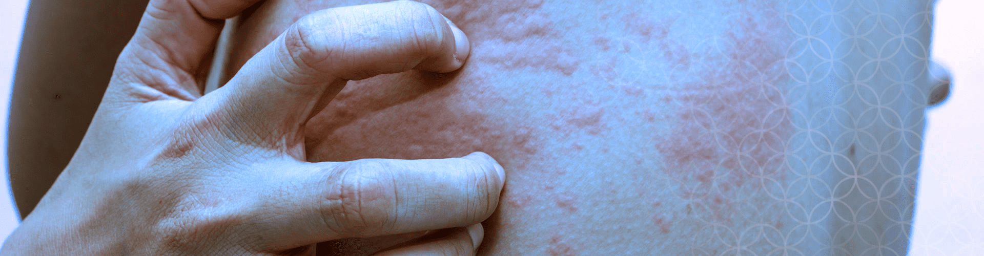 Mast Cell Activation Syndrome Rash